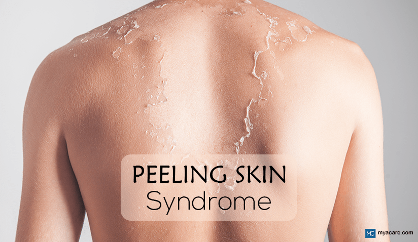 PEELING SKIN SYNDROME: CAUSES, SYMPTOMS, AND MANAGEMENT | Mya Care